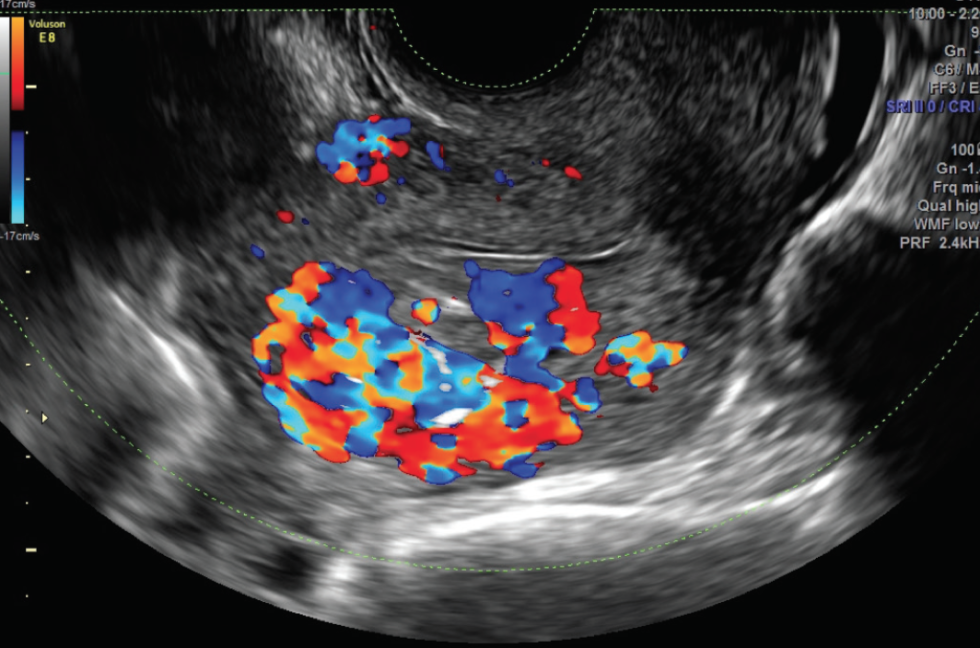 Color doppler | Centromedica